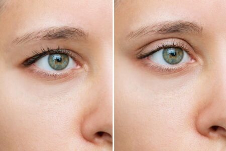 Hooded Eye Surgery Secrets, The Quiet Fix Behind Hollywood’s Most ...