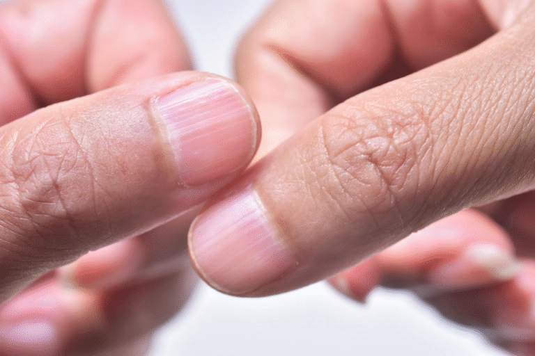 Vertical Ridges On Nails Vitamin Deficiency, What Your Fingertips Might ...